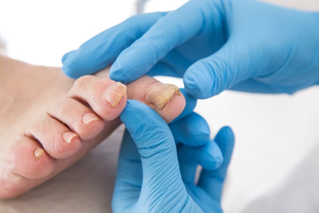 Fungal Skin & Toe Nails - Brindabella Podiatry - Book a Podiatrist today!