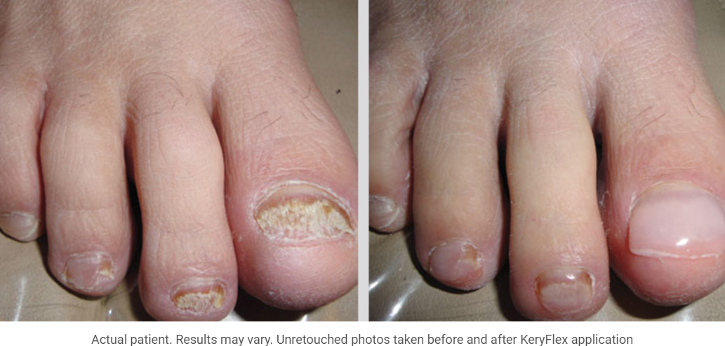 KeryFlex Nail Restoration - Brindabella Podiatry - See a Podiatrist today!