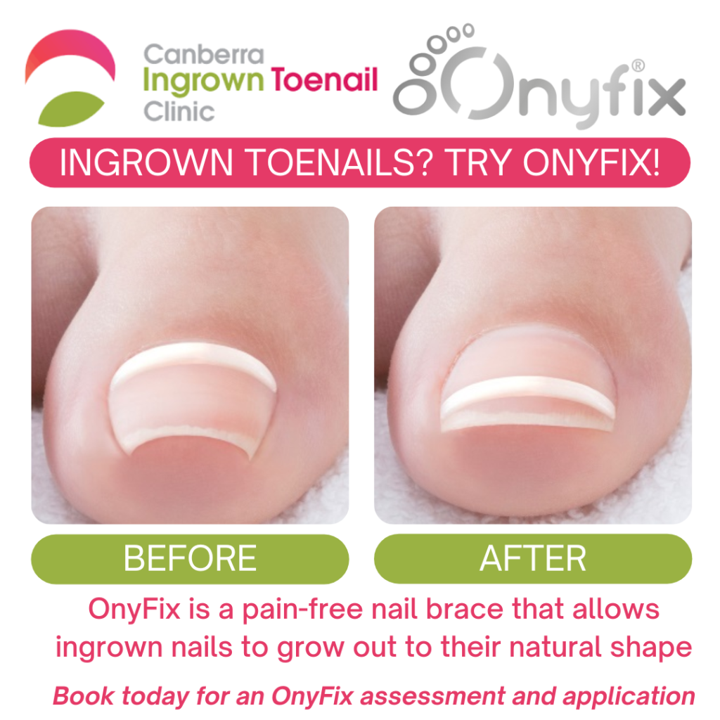 I don't like the look of my nails - Brindabella Podiatry