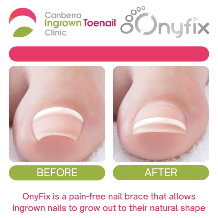 Brindabella Podiatry - Book to see a Podiatrist today!